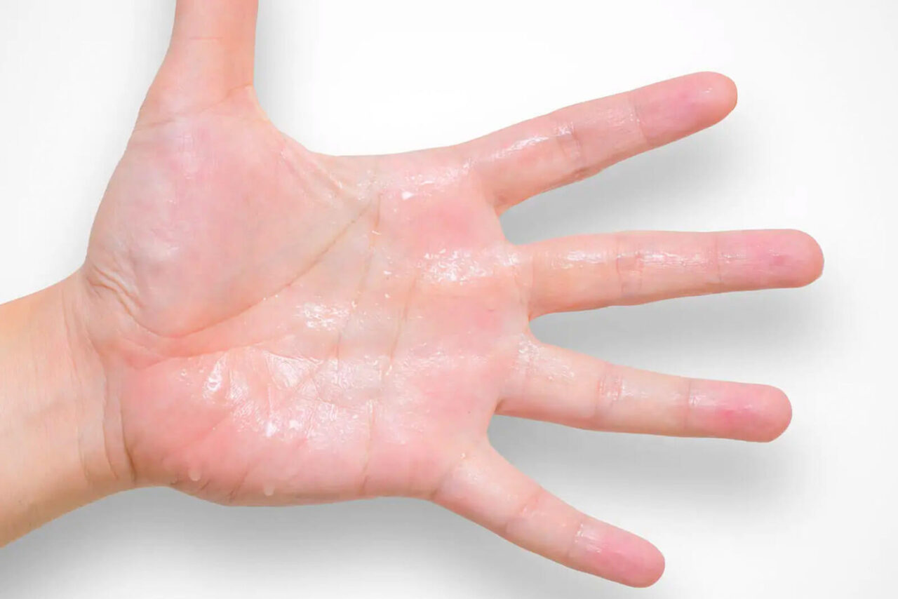 Hyperhidrosis Treatment | Skin Condition Treatments | We also provide ...