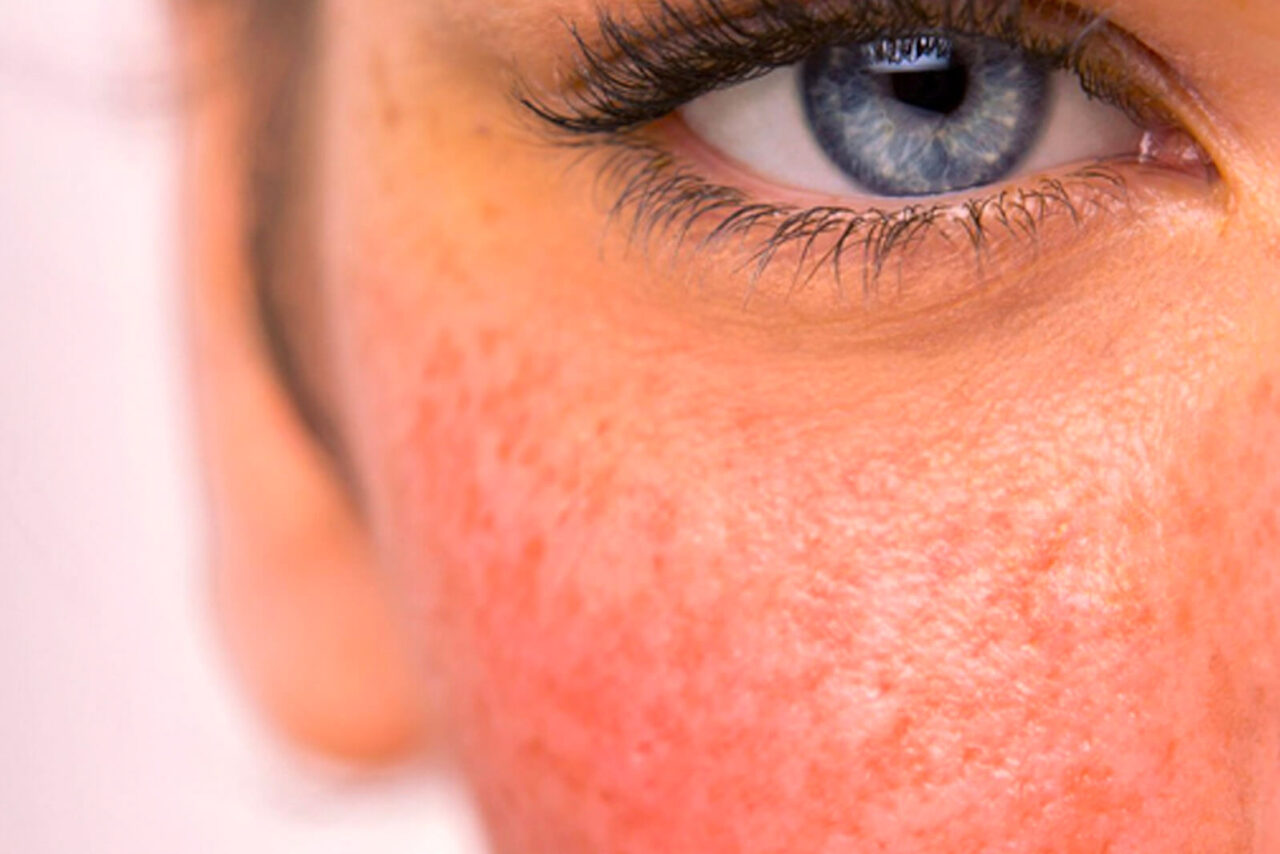 Rosacea Treatment | Skin Condition Treatments | We also provide hormone ...