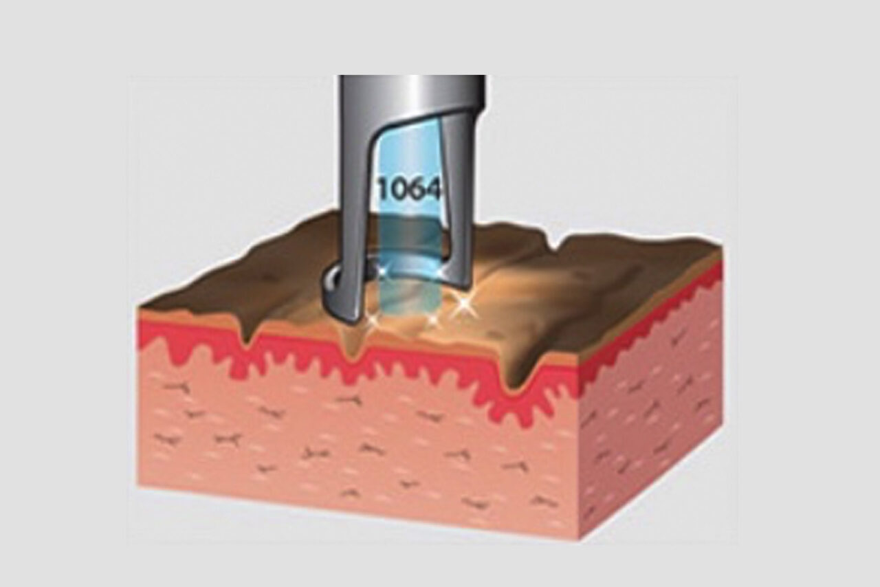Sciton MicroLaserPeel® | Skin Rejuvenation & Resurfacing | We also ...