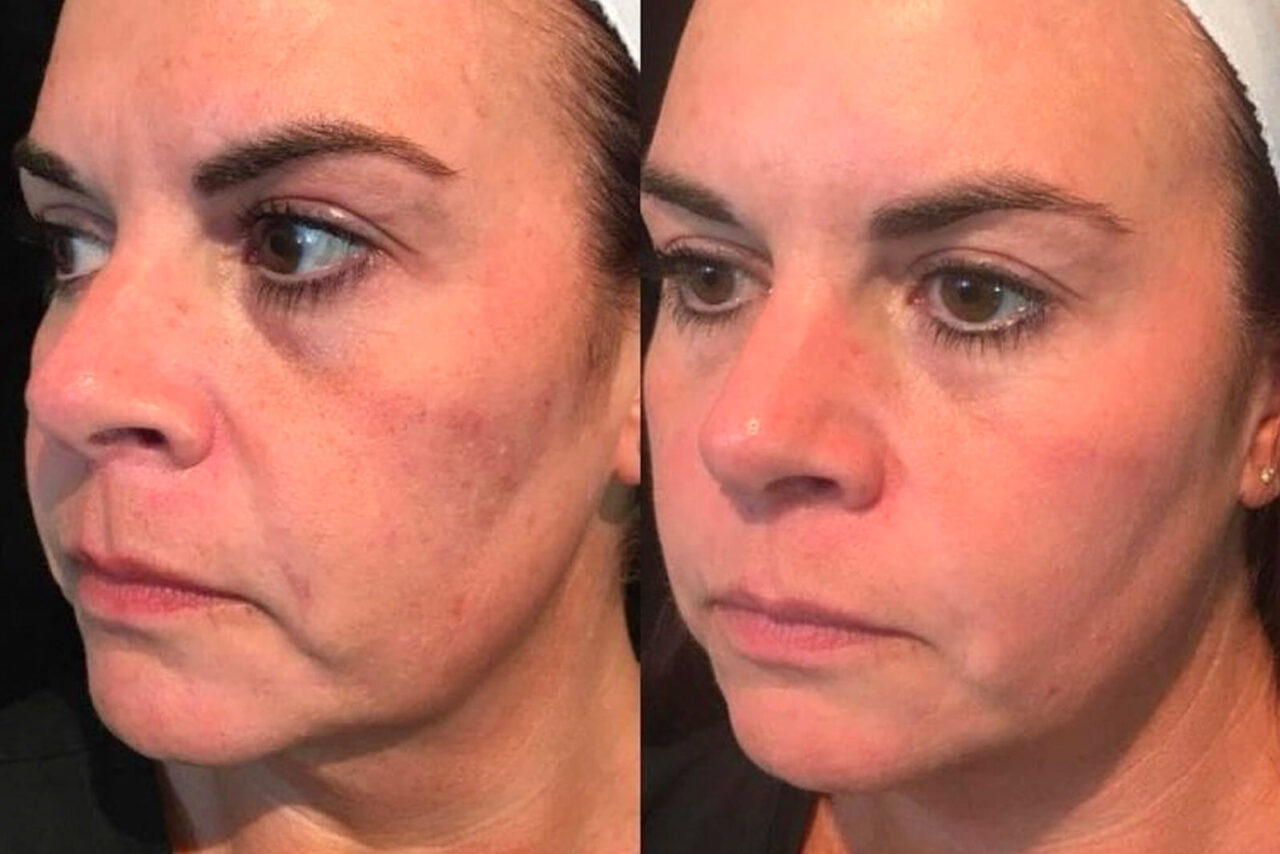 Sciton MicroLaserPeel® | Skin Rejuvenation & Resurfacing | We also ...