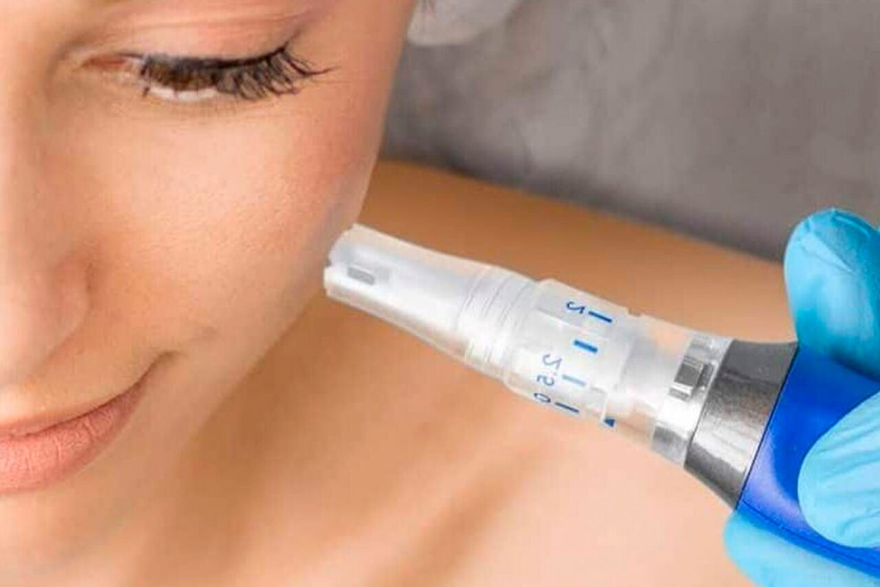 SkinPen® by Bellus Medical - PRP/Micro-Needling | Skin Rejuvenation & Resurfacing | We also ...